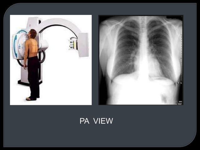 Interpretation of chest x-rays | PPTX
