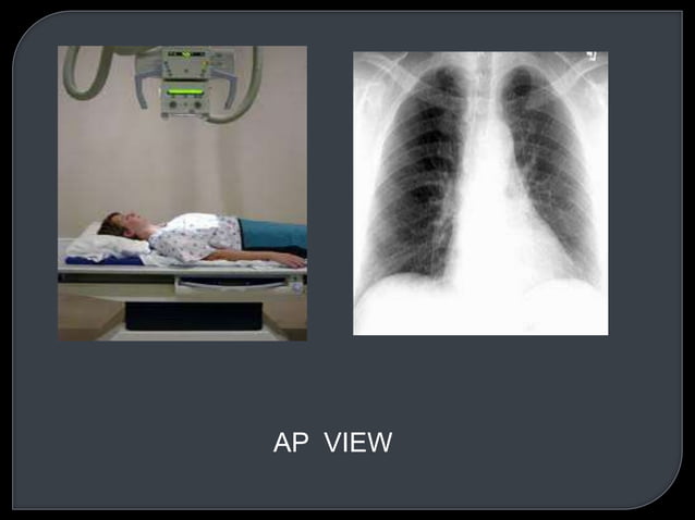 Interpretation of chest x-rays | PPTX