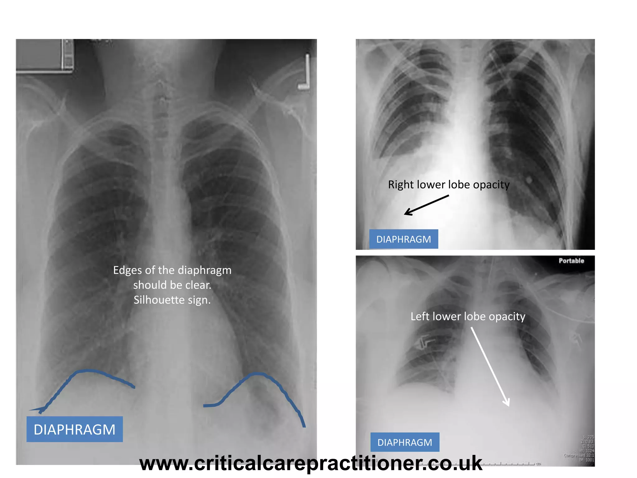 The structured interpretation of chest x rays. | PPTX