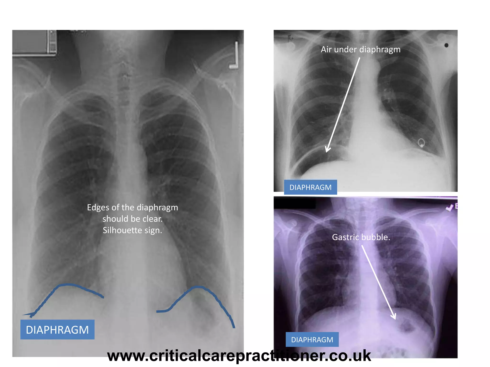 The structured interpretation of chest x rays. | PPTX