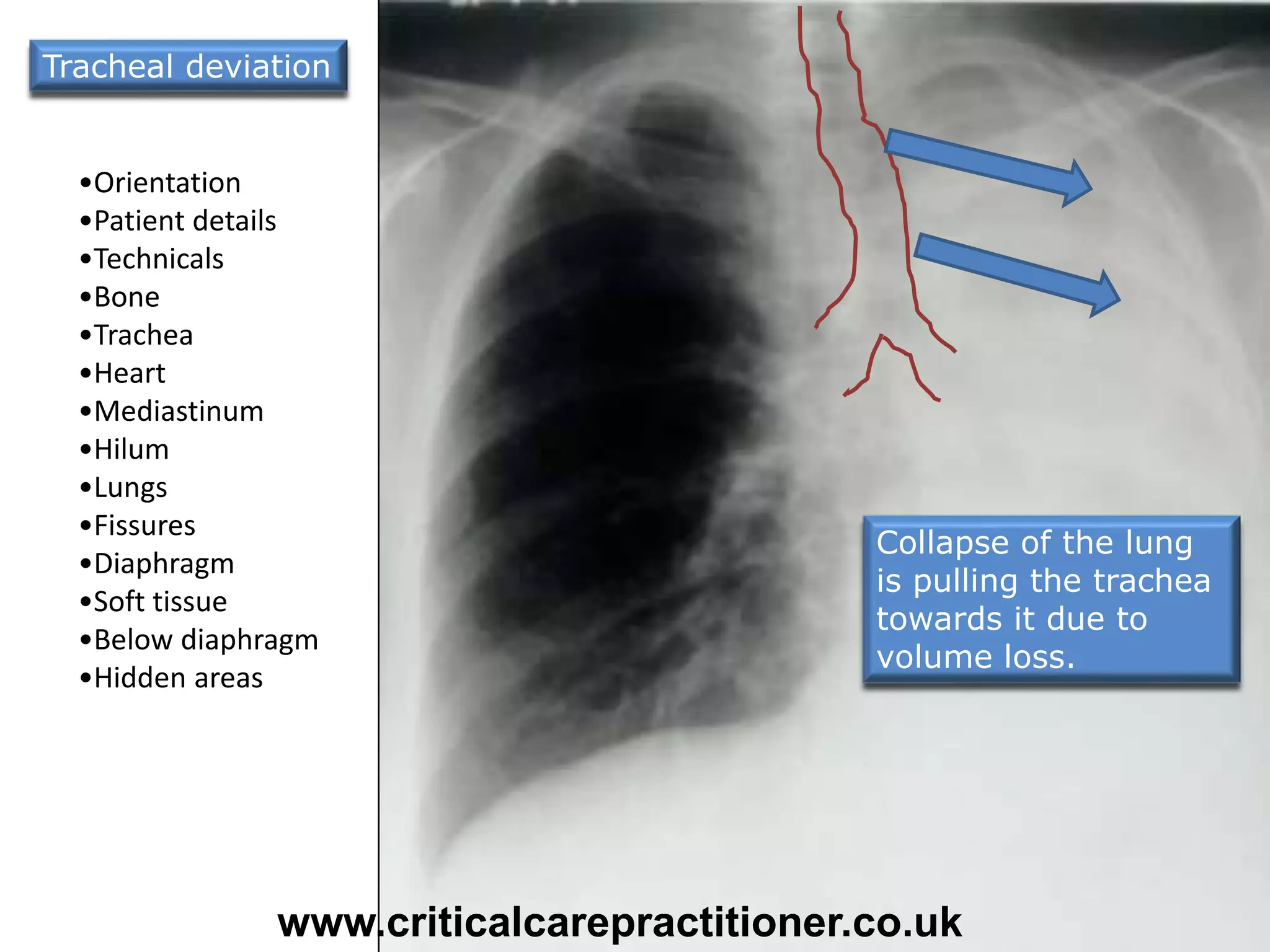 The structured interpretation of chest x rays. | PPTX
