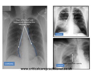 The structured interpretation of chest x rays. | PPTX