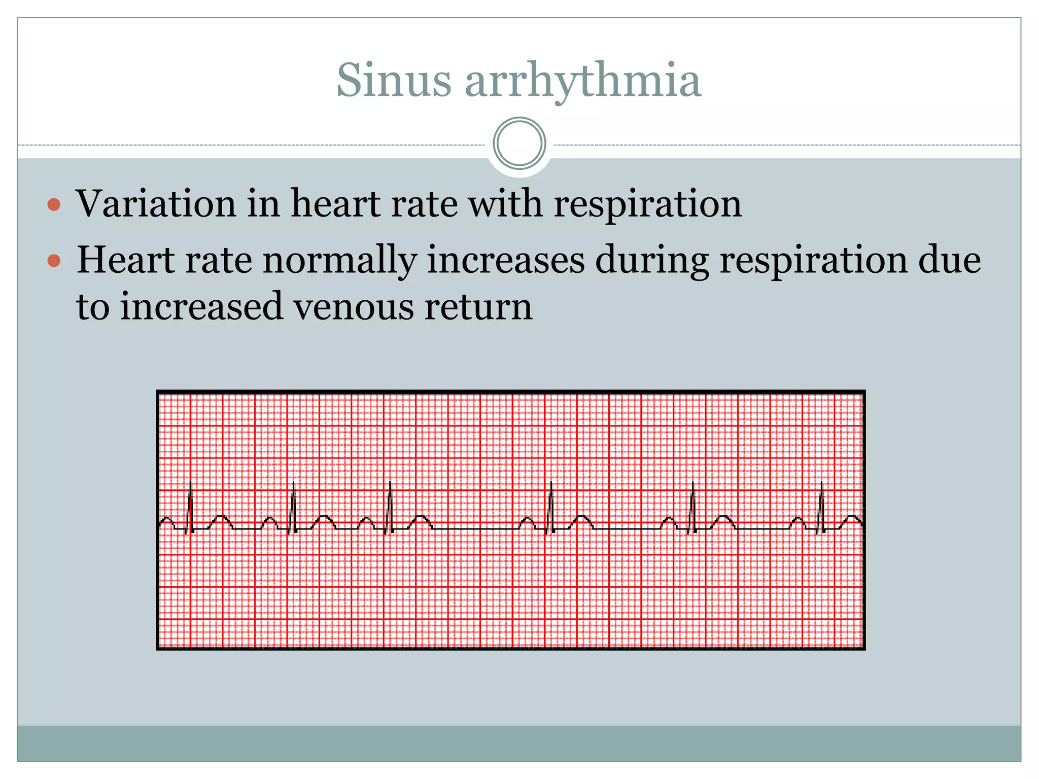 Interpretation of common ecg abnormalities | PPTX