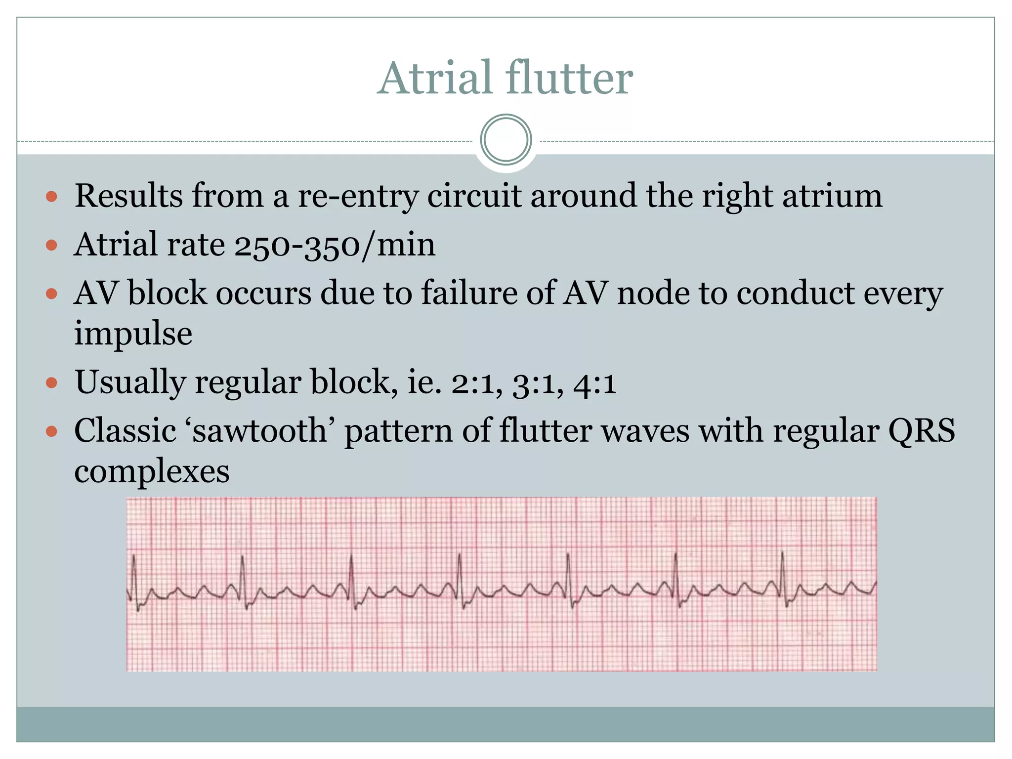 Interpretation of common ecg abnormalities | PPTX