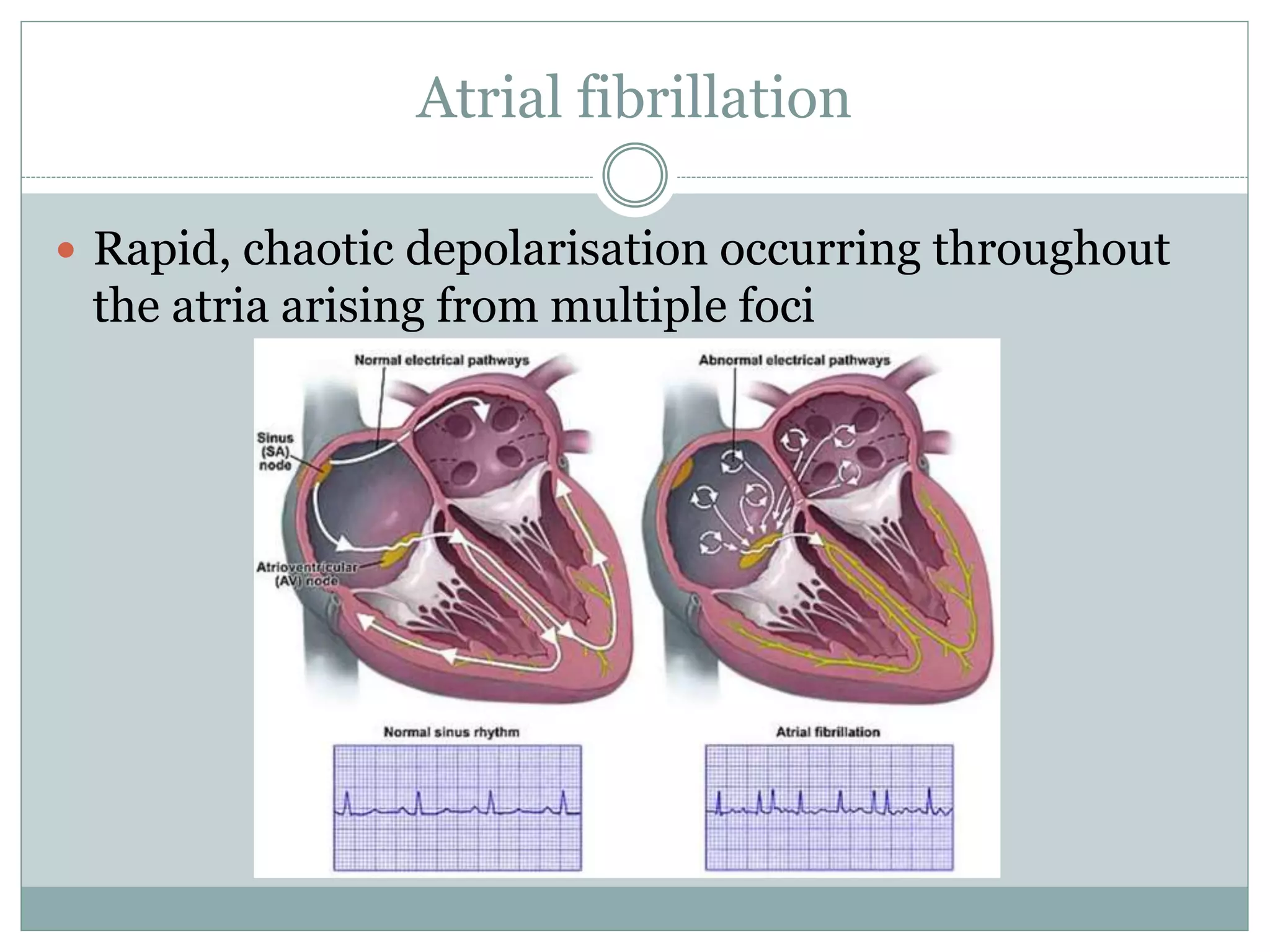 Interpretation of common ecg abnormalities | PPTX