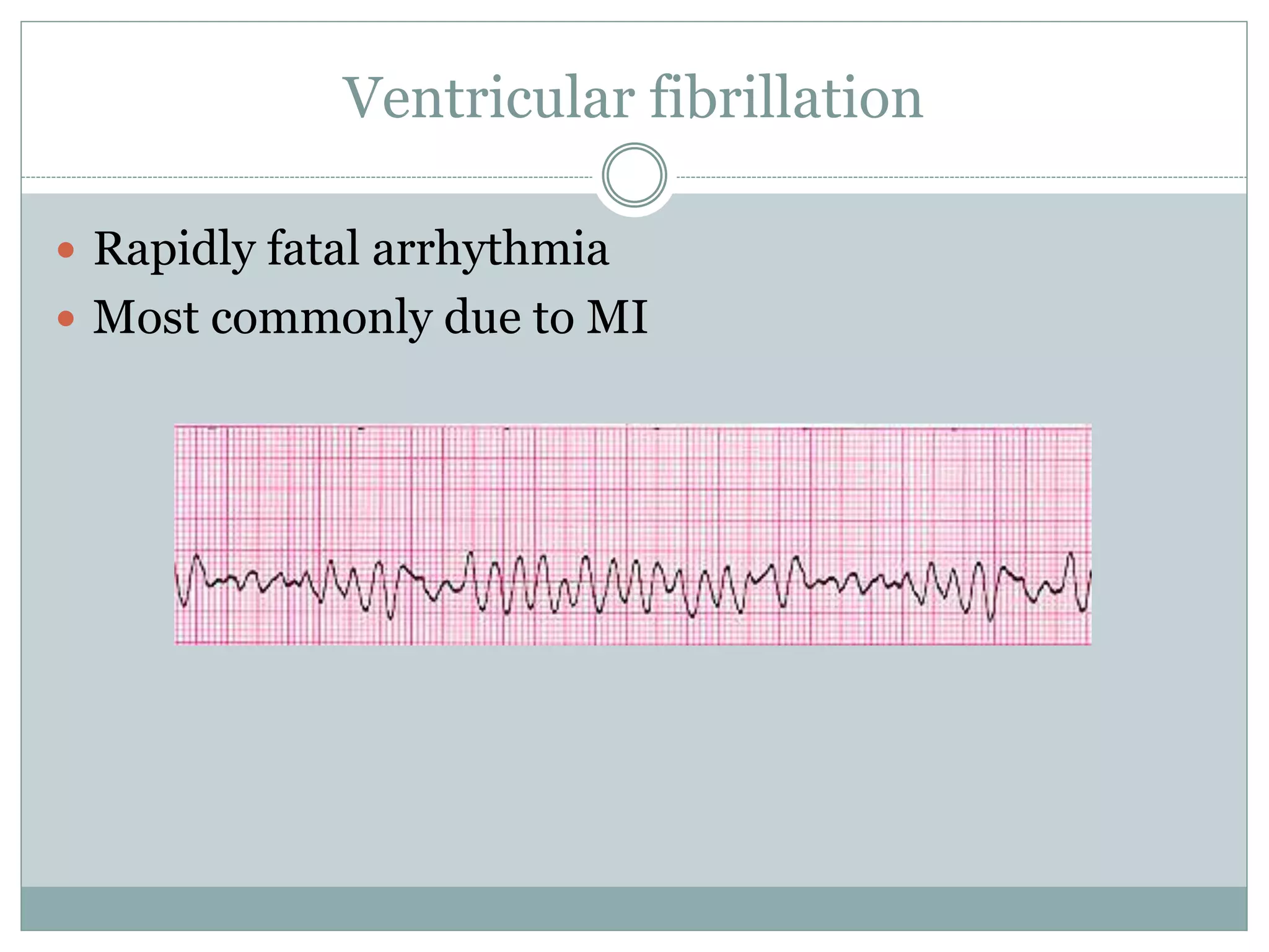 Interpretation of common ecg abnormalities | PPTX