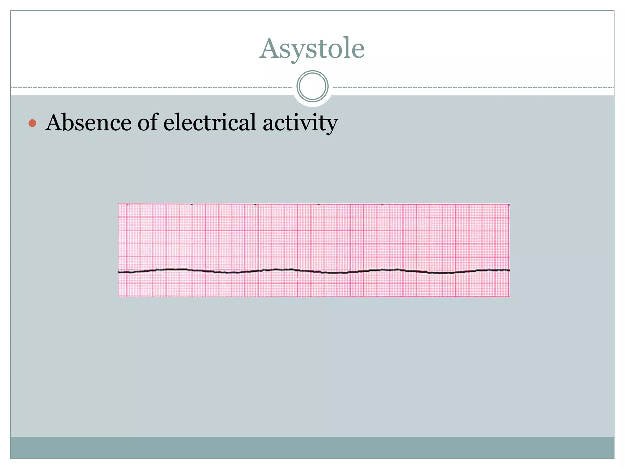 Interpretation of common ecg abnormalities | PPTX