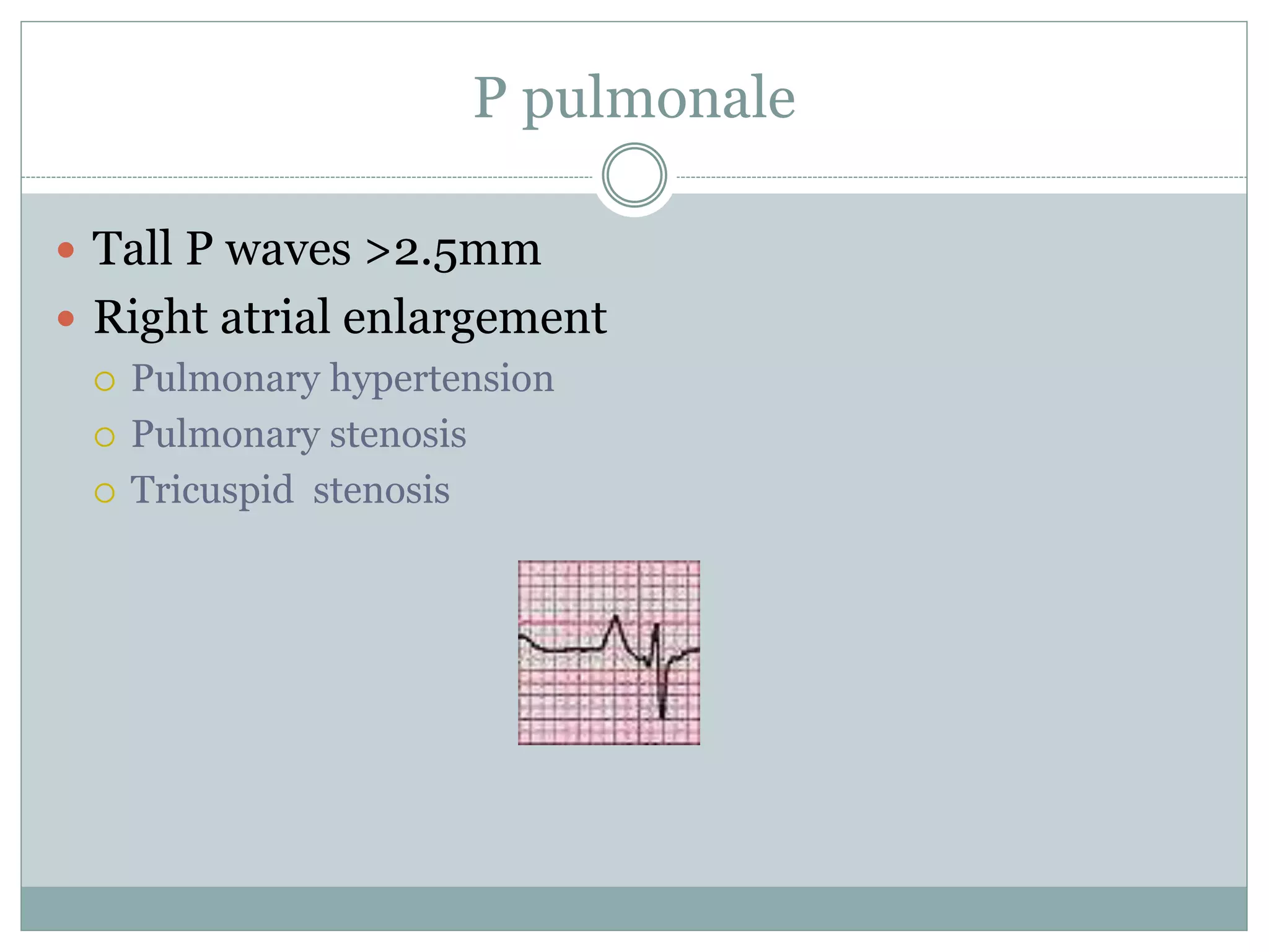 Interpretation of common ecg abnormalities | PPTX
