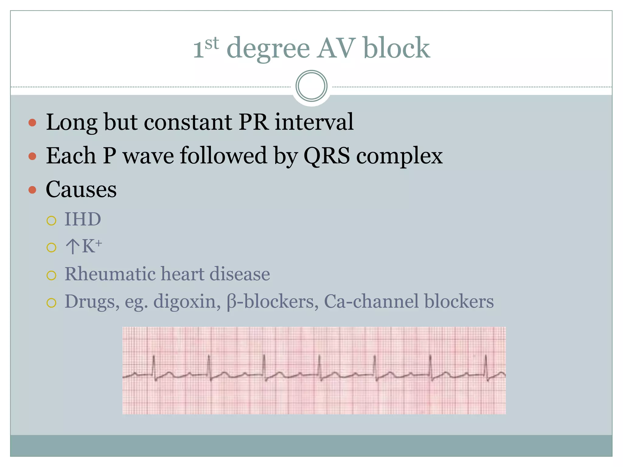 Interpretation of common ecg abnormalities | PPTX