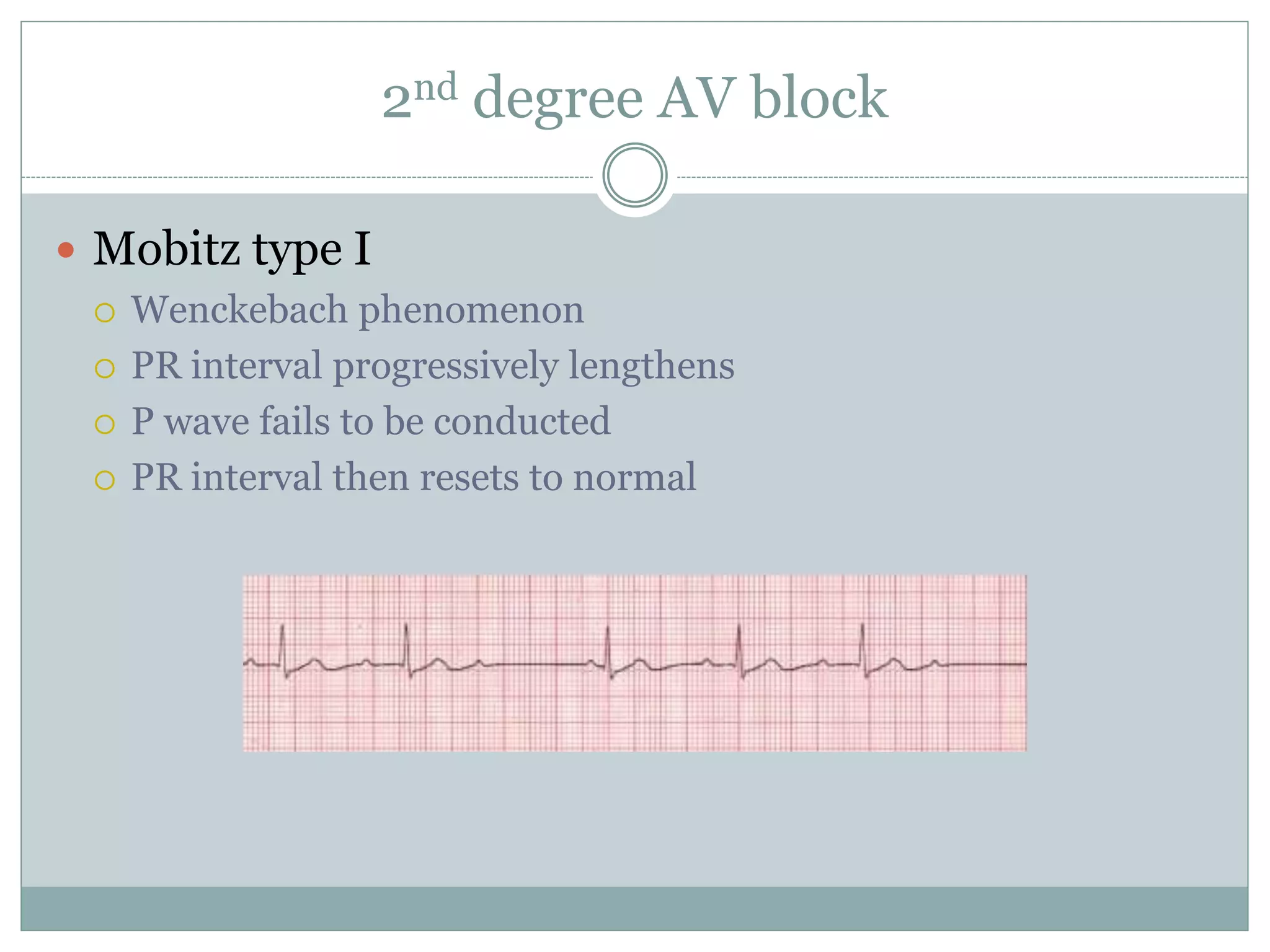Interpretation of common ecg abnormalities | PPTX