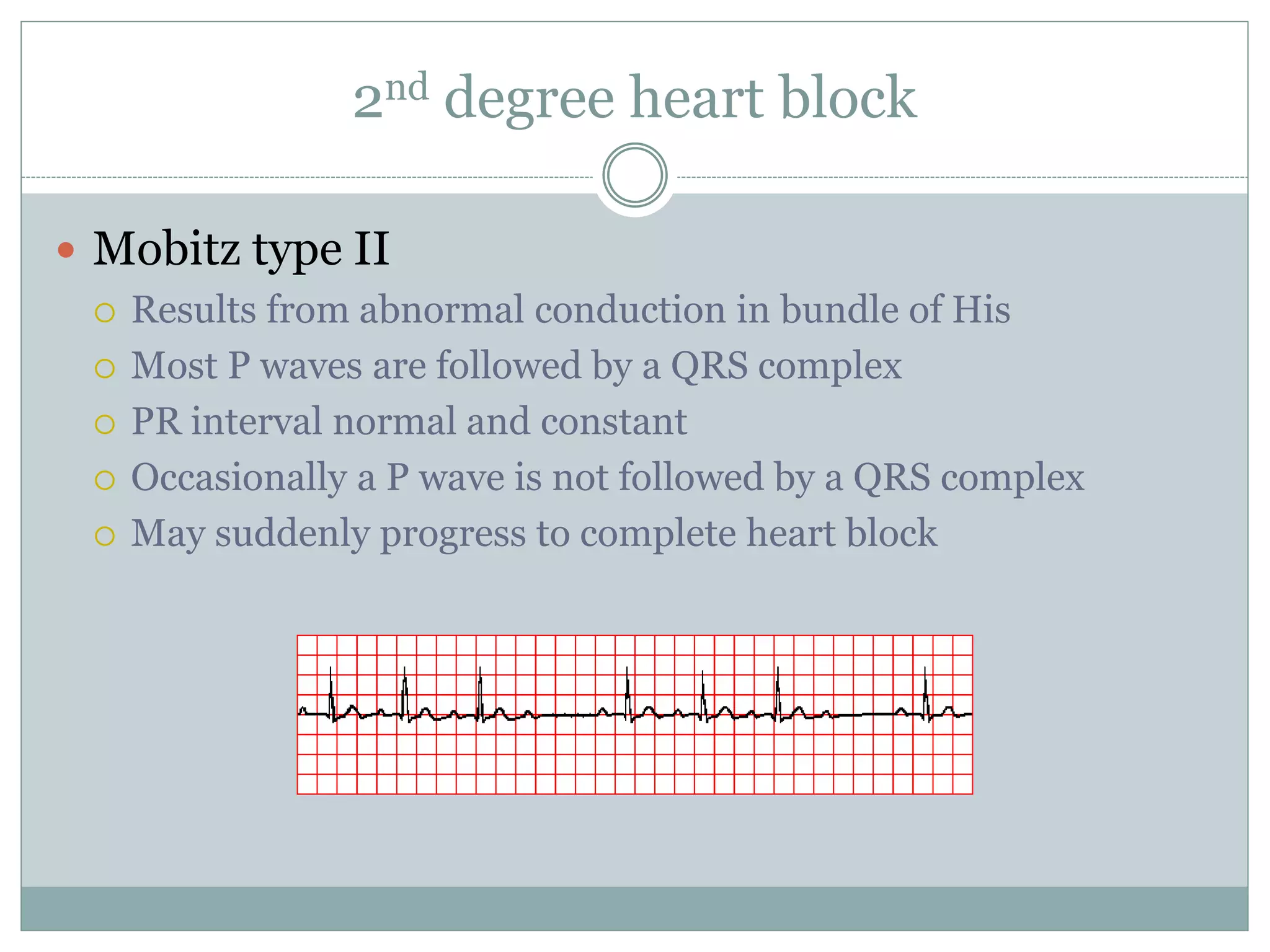 Interpretation of common ecg abnormalities | PPTX