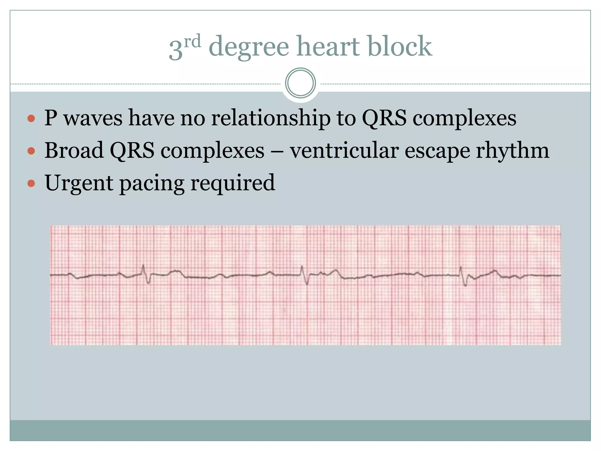 Interpretation of common ecg abnormalities | PPTX