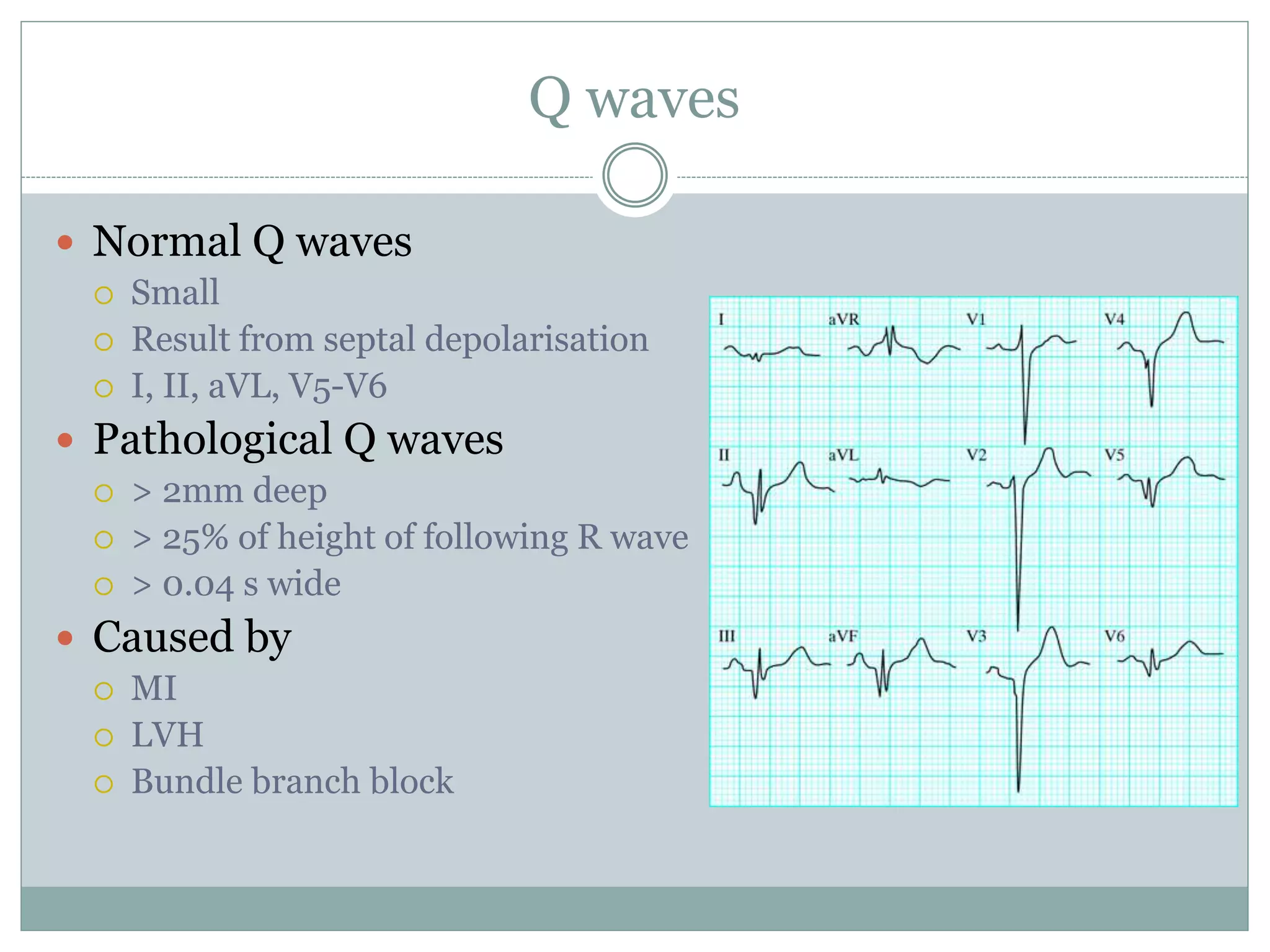 Interpretation of common ecg abnormalities | PPTX