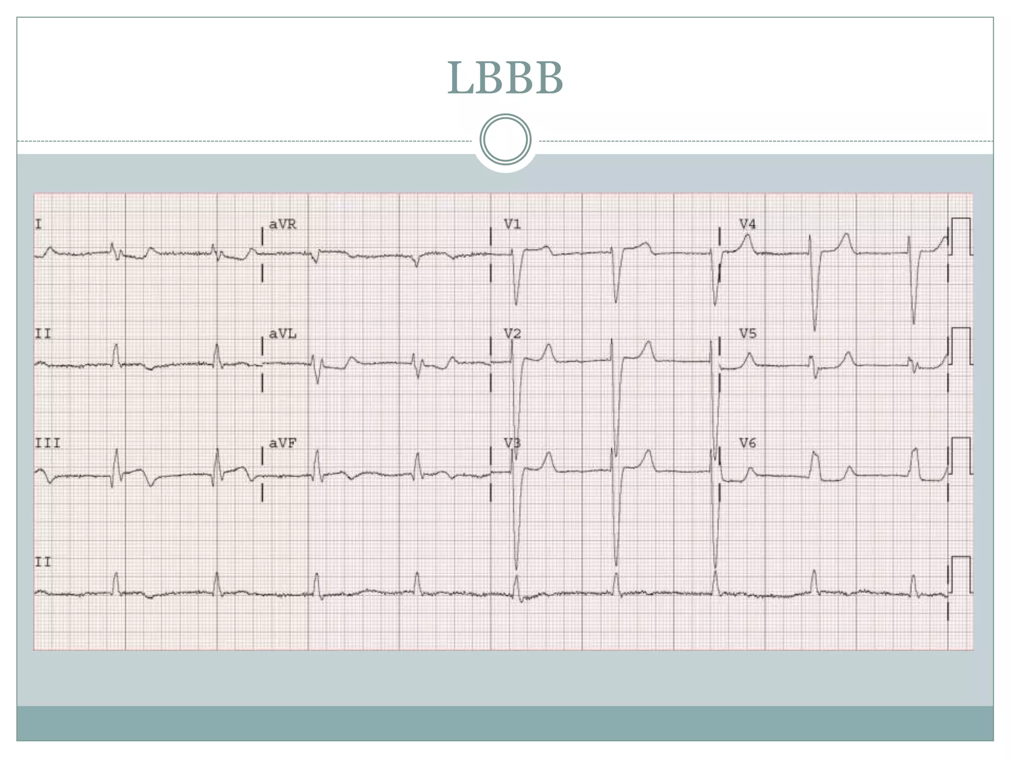 Interpretation of common ecg abnormalities | PPTX