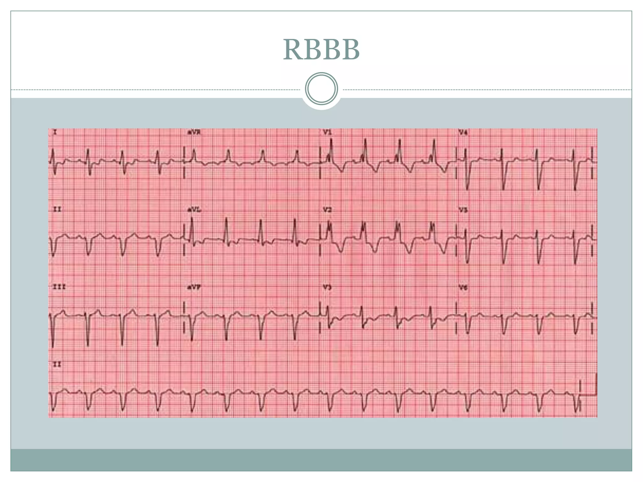 Interpretation of common ecg abnormalities | PPTX