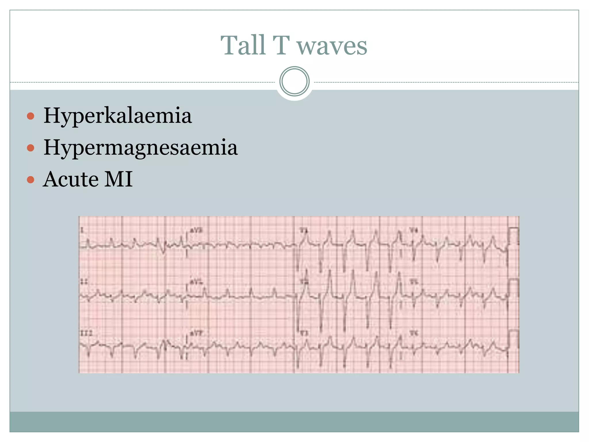 Interpretation of common ecg abnormalities | PPTX
