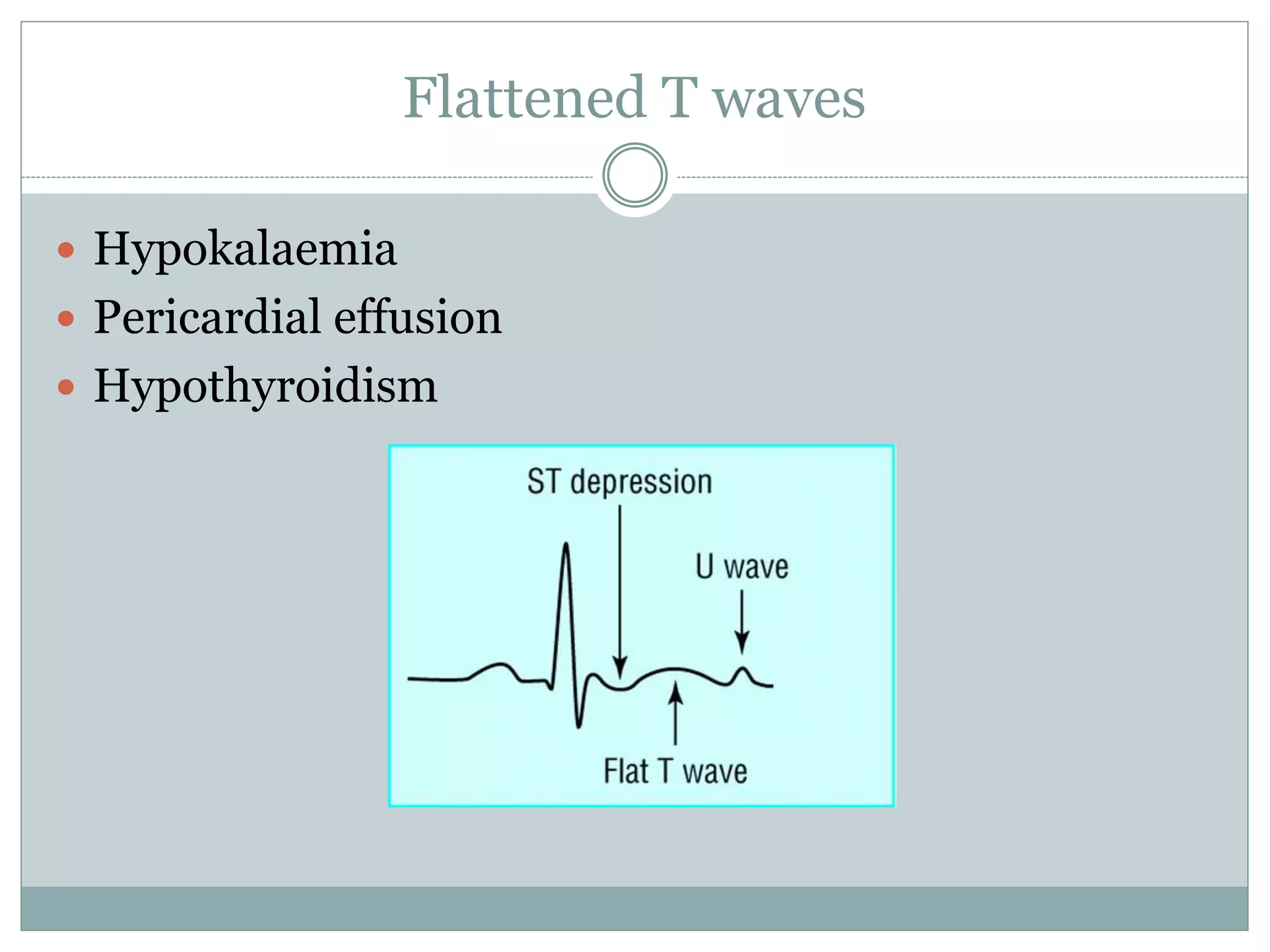 Interpretation of common ecg abnormalities | PPTX