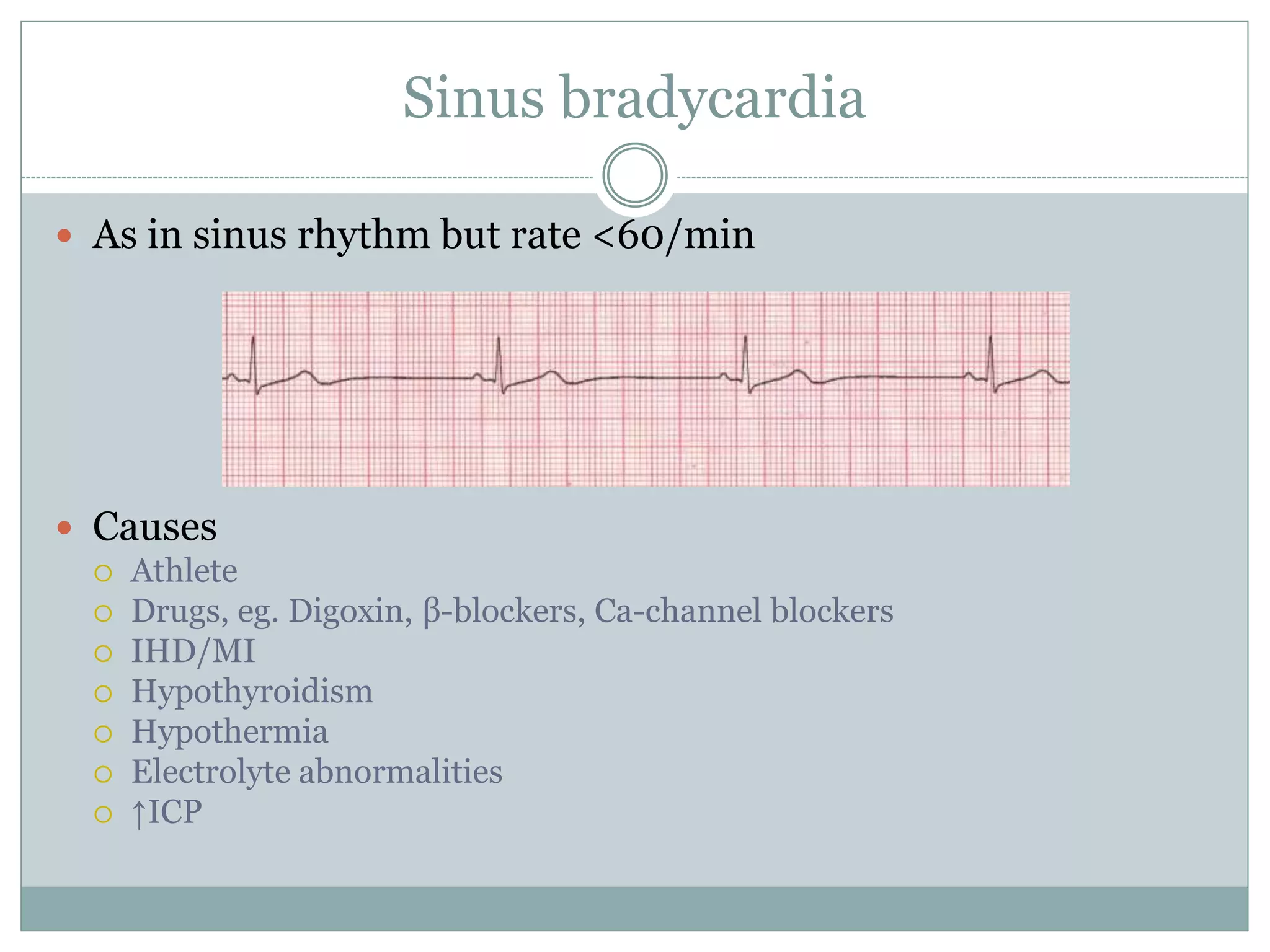 Interpretation of common ecg abnormalities | PPTX