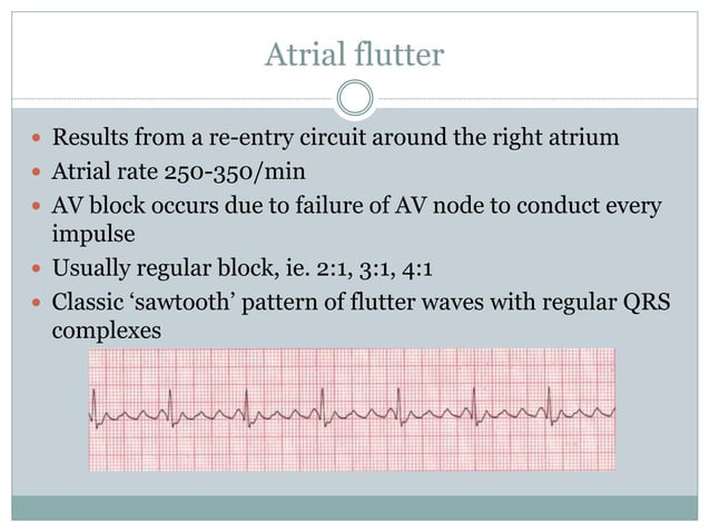 Interpretation of common ecg abnormalities | PPTX