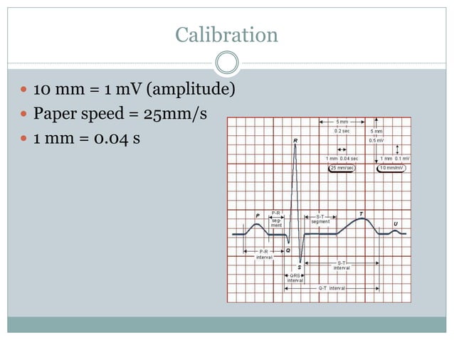 Interpretation of common ecg abnormalities | PPTX
