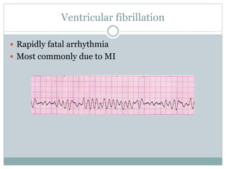 Interpretation of common ecg abnormalities | PPTX