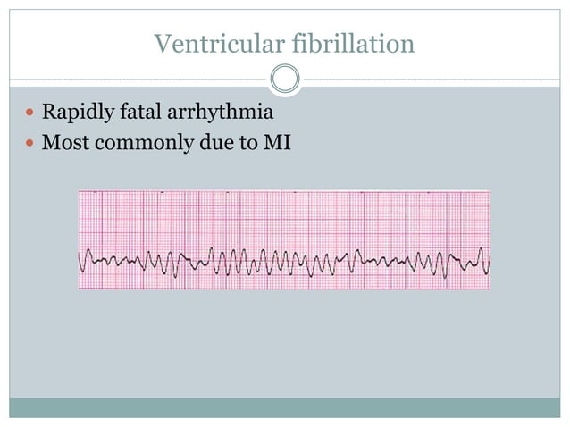 Interpretation of common ecg abnormalities | PPTX