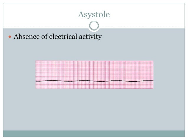 Interpretation of common ecg abnormalities | PPTX