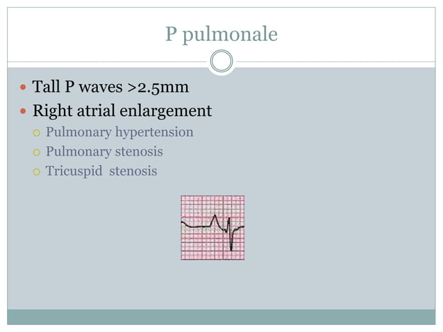 Interpretation of common ecg abnormalities | PPTX