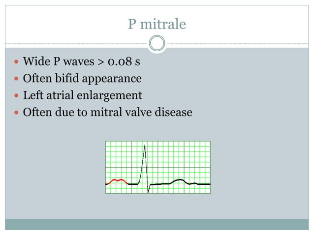 Interpretation of common ecg abnormalities | PPTX