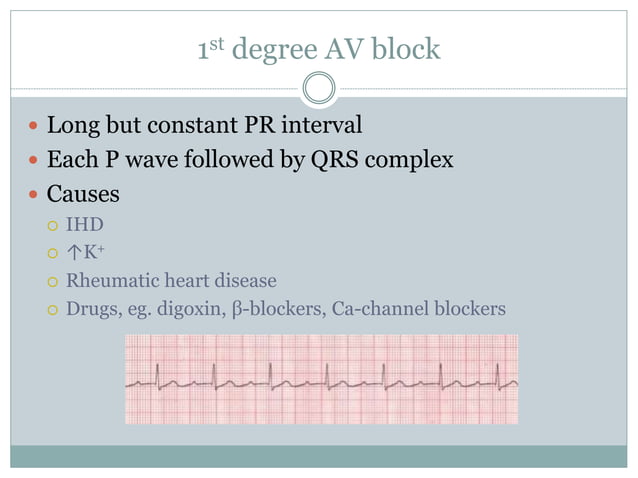 Interpretation of common ecg abnormalities | PPTX