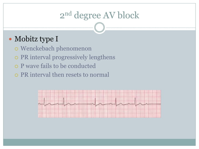 Interpretation of common ecg abnormalities | PPTX
