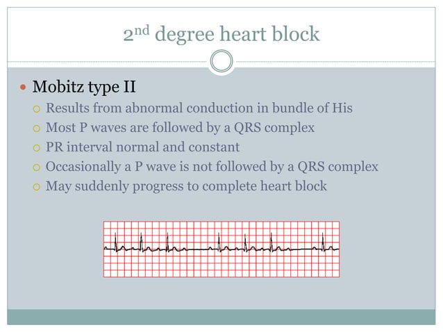Interpretation of common ecg abnormalities | PPTX