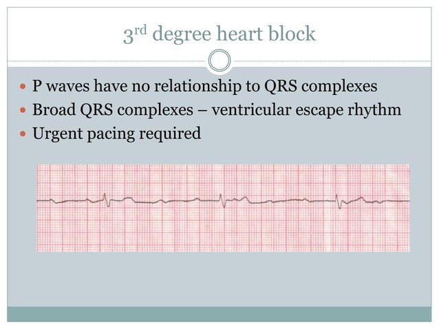 Interpretation of common ecg abnormalities | PPTX