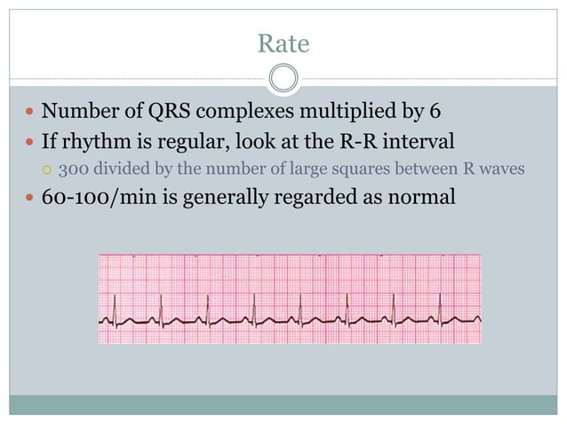 Interpretation of common ecg abnormalities | PPTX