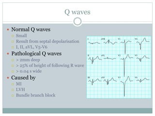 Interpretation of common ecg abnormalities | PPTX