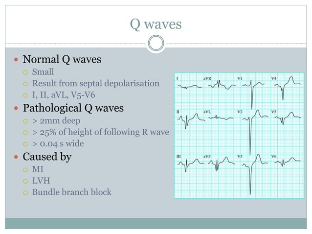 Interpretation of common ecg abnormalities | PPTX