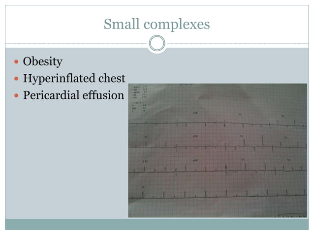 Interpretation of common ecg abnormalities | PPTX
