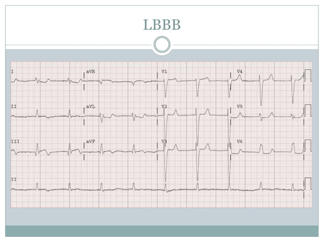 Interpretation of common ecg abnormalities | PPTX