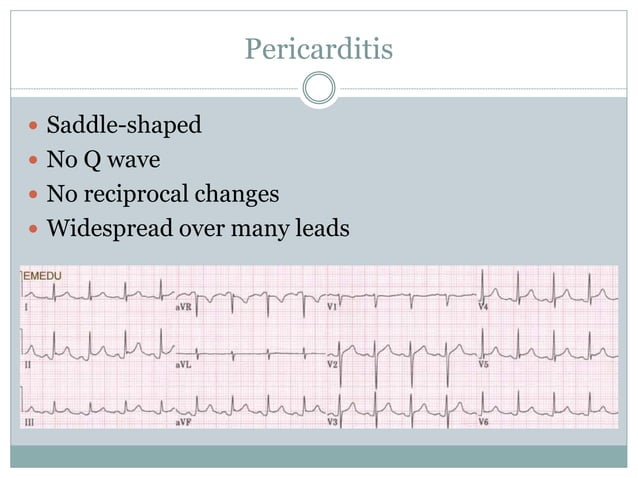 Interpretation of common ecg abnormalities | PPTX