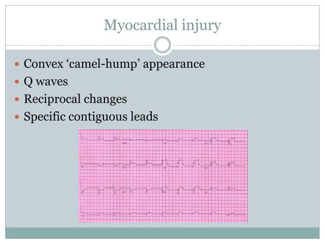 Interpretation of common ecg abnormalities | PPTX