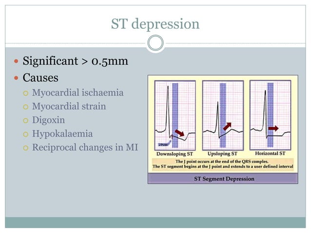 Interpretation of common ecg abnormalities | PPTX