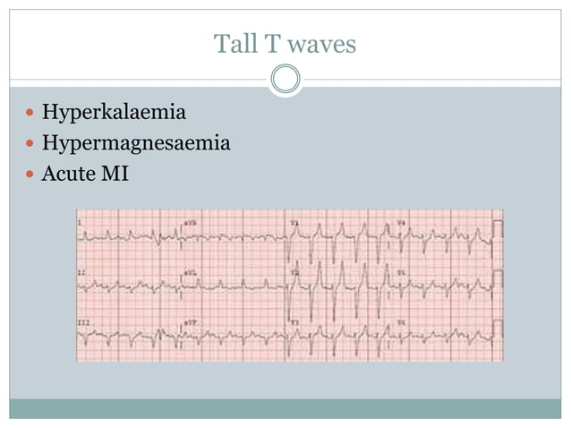 Interpretation of common ecg abnormalities | PPTX