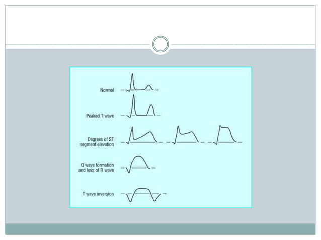 Interpretation of common ecg abnormalities | PPTX