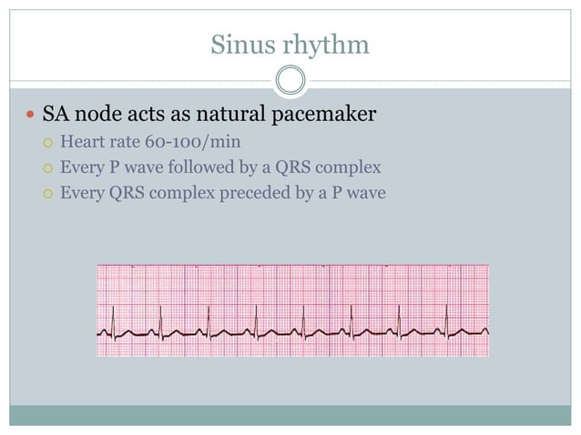 Interpretation of common ecg abnormalities | PPTX