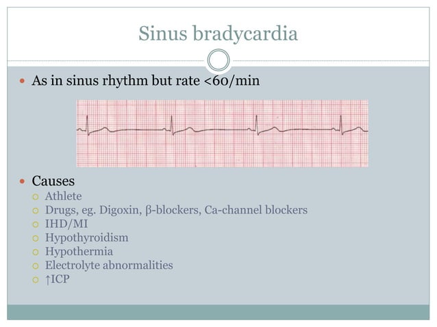 Interpretation of common ecg abnormalities | PPTX