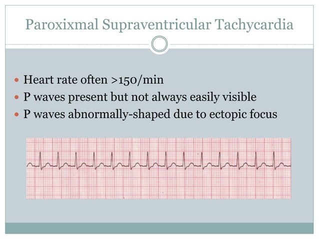 Interpretation of common ecg abnormalities