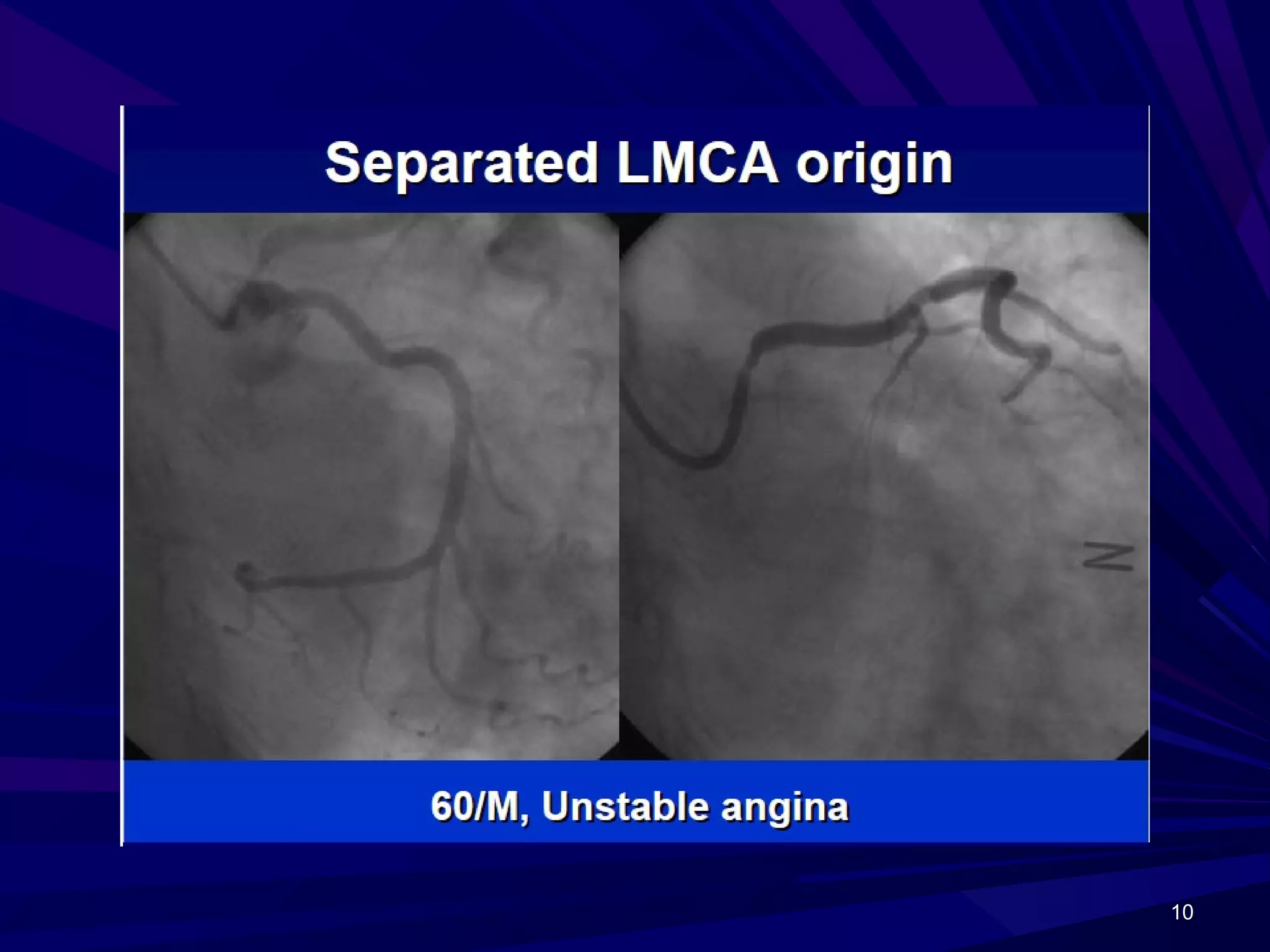 Interpretation of coronary angiogram | PPT