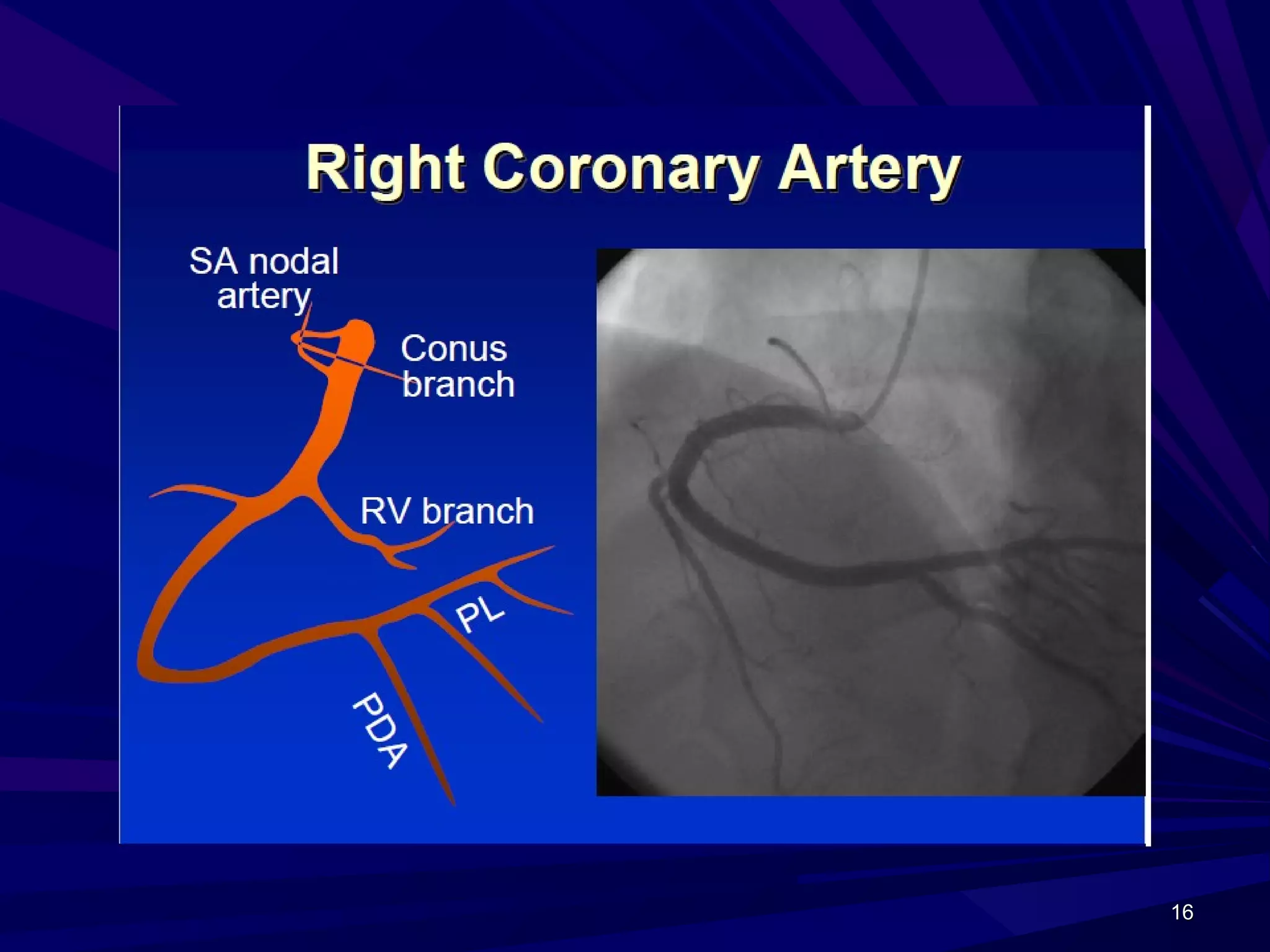 Interpretation of coronary angiogram | PPT