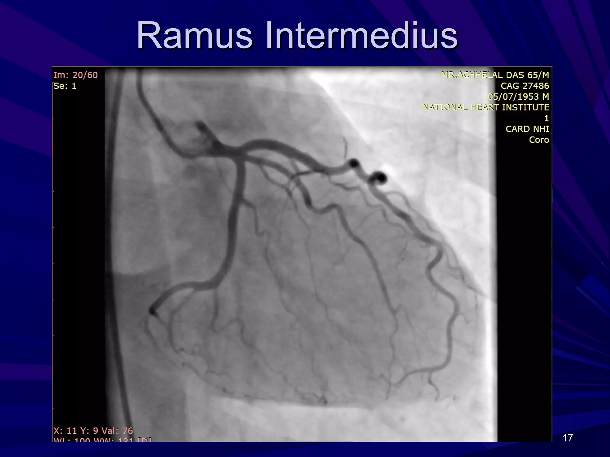 Interpretation of coronary angiogram | PPT
