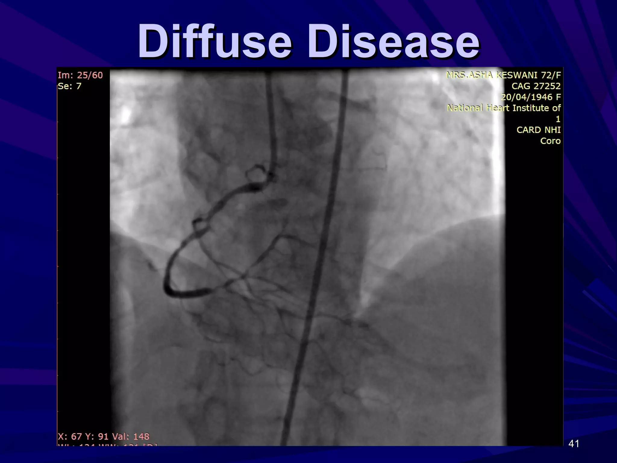 Interpretation of coronary angiogram | PPT